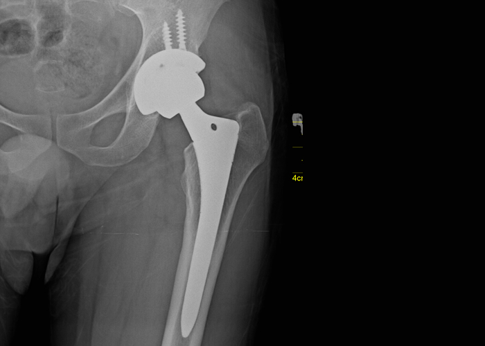 TOTAL HIP REPLACEMENT CASES