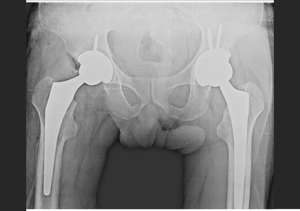 TOTAL HIP REPLACEMENT CASES