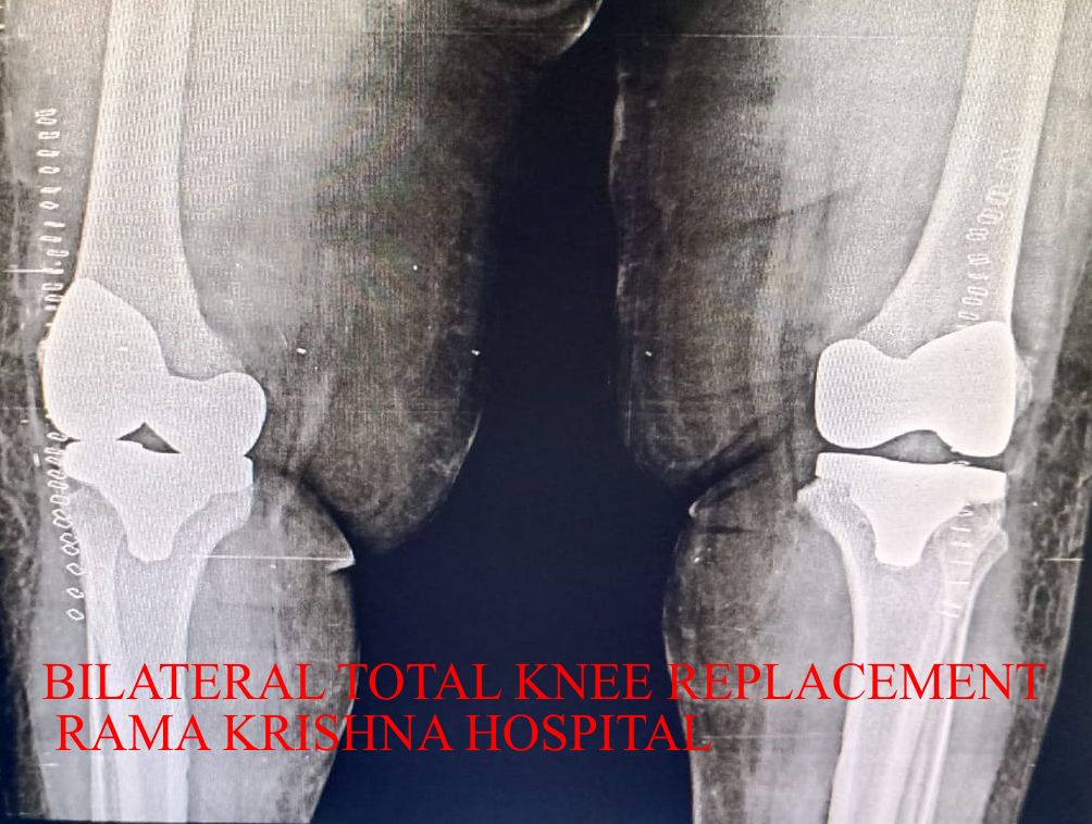 TOTAL KNEE REPLACEMENT CASES